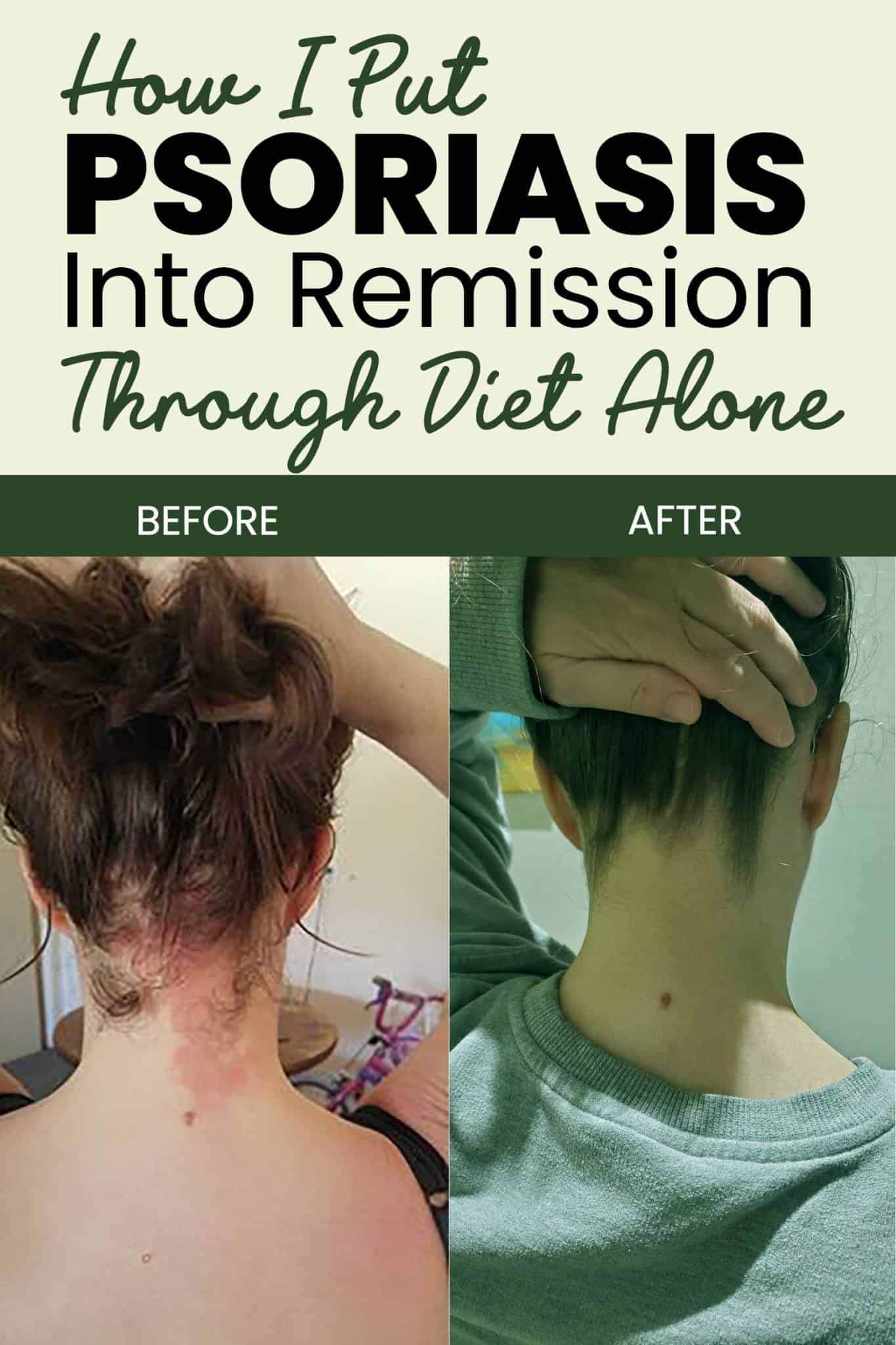 My Psoriasis Diet That Really Works (Before & After Pics)